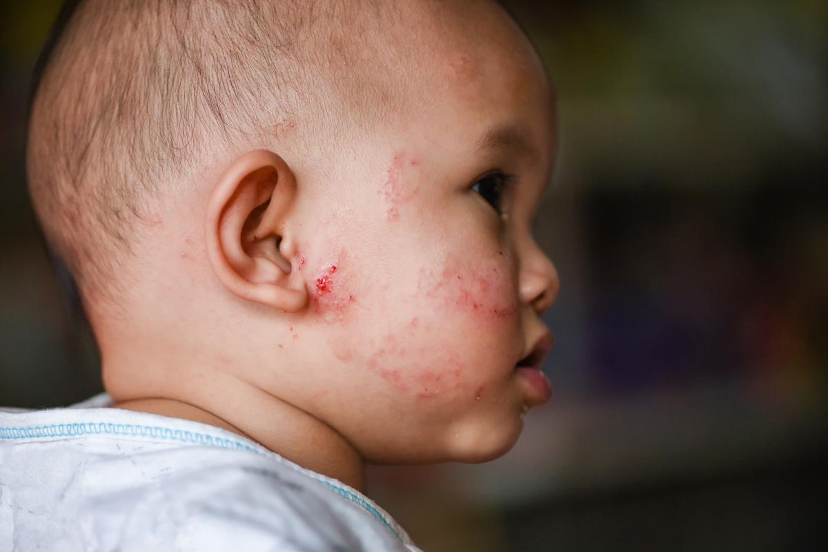 Eccema en bebés o dermatitis atópica: causas y tratamiento