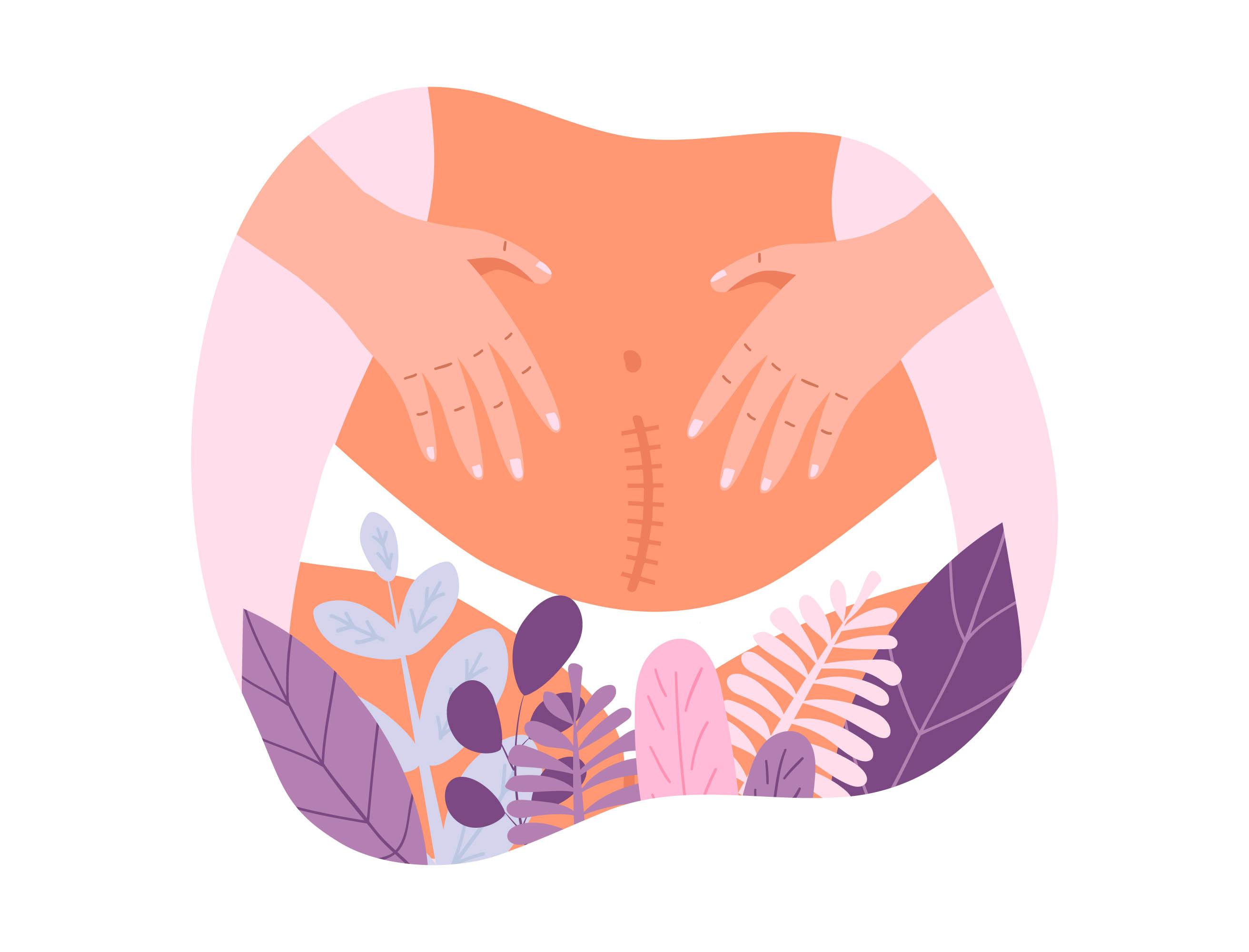 Cómo cuidar la herida de una cesárea después de quitar los puntos