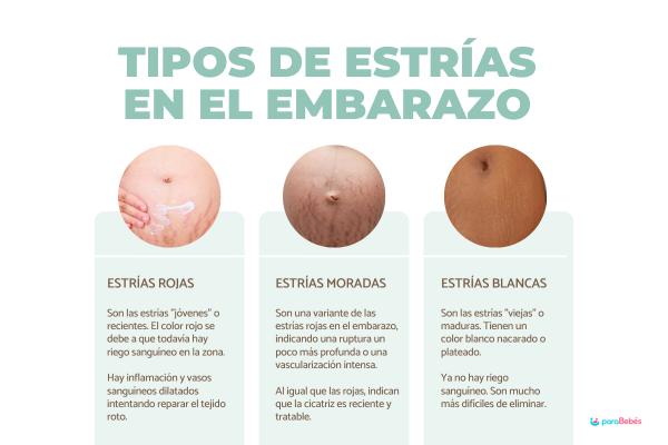 Estrías en el embarazo: cuándo salen y cómo eliminarlas