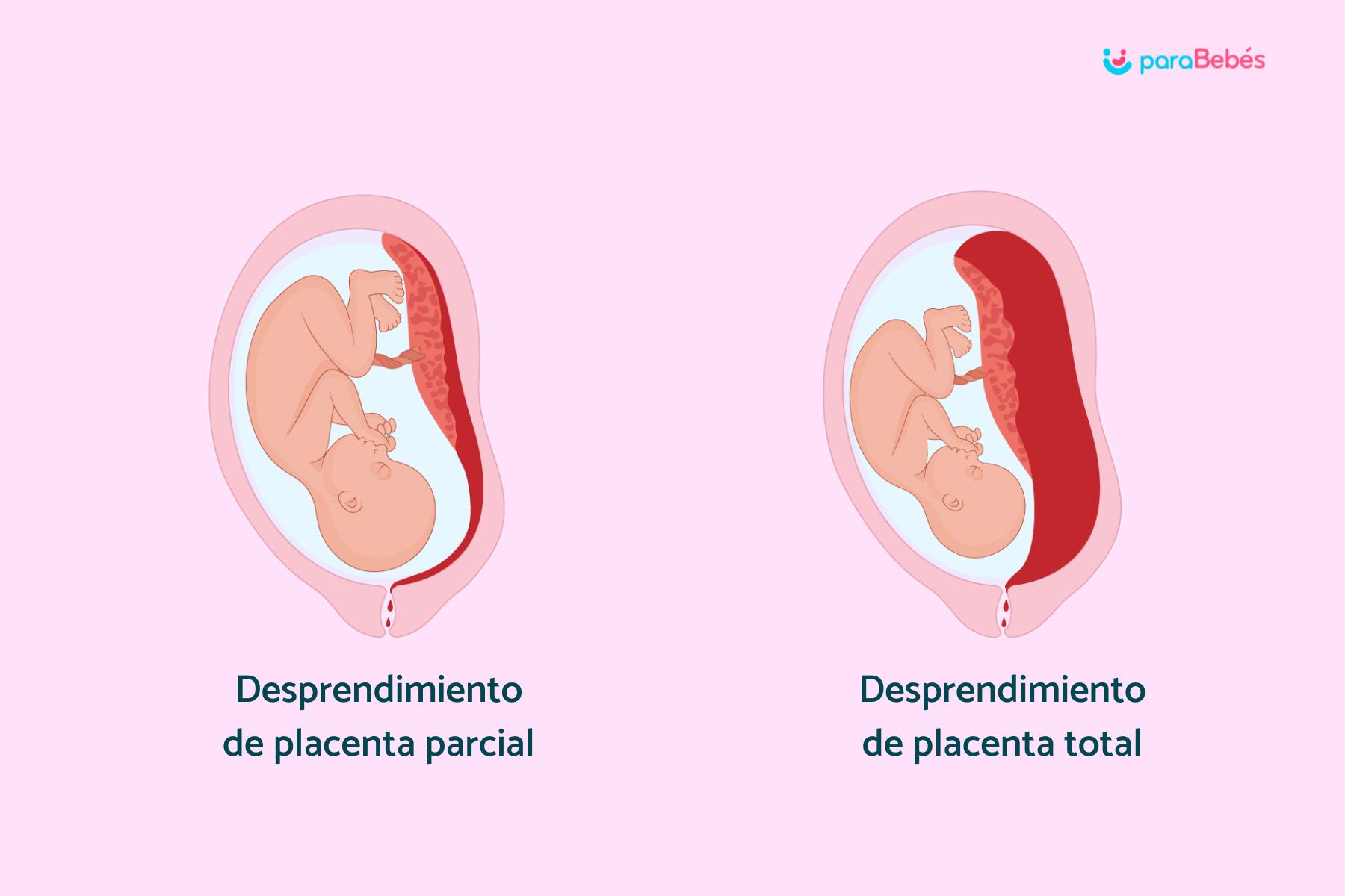 Desprendimiento de placenta: síntomas, causas y riesgos