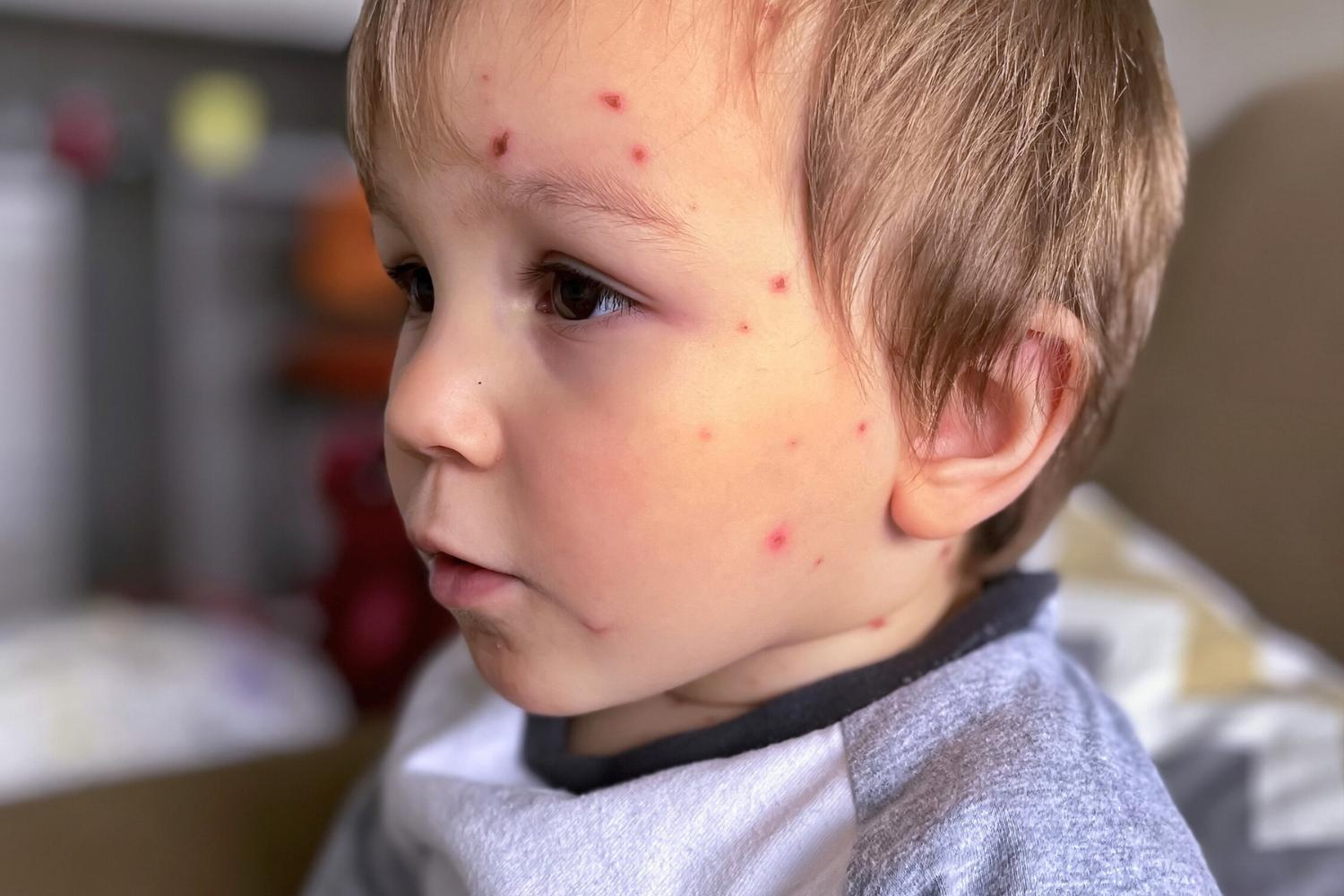 Varicela en bebés: síntomas, tratamiento y prevención