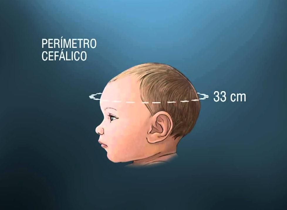 Qué es la microcefalia en un bebé y cuáles son sus complicaciones