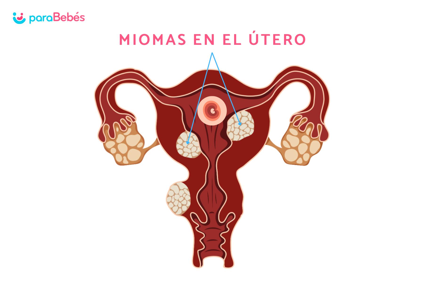 Qué pasa si tengo miomas en el útero y estoy embarazada
